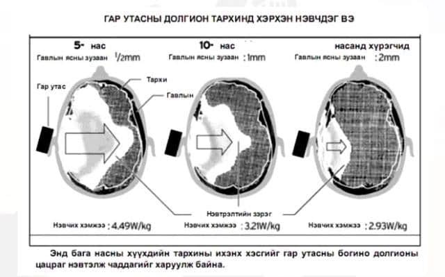 Гар утас хүүхдэд тархины хорт хавдар үүсгэдэг Tac Mn